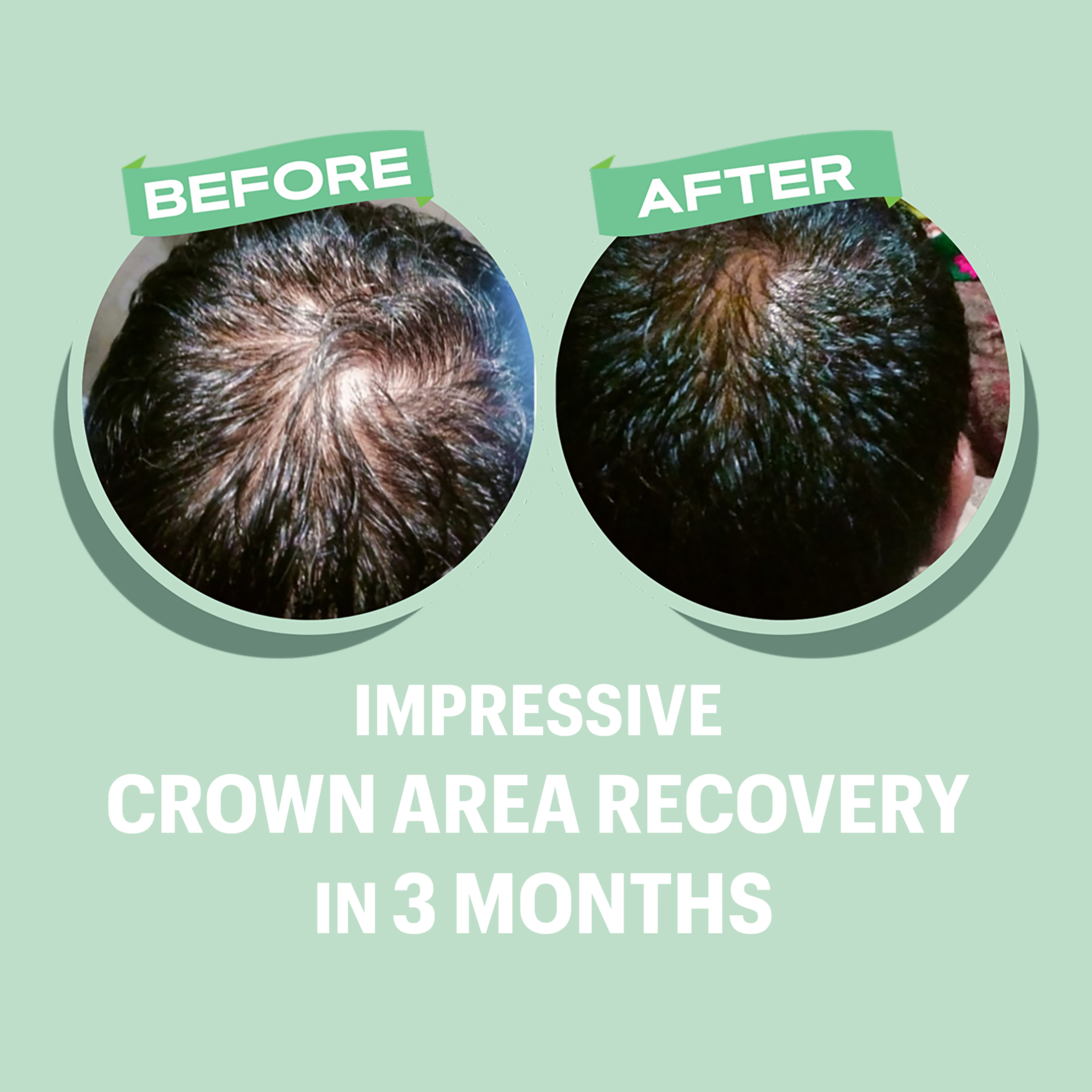 Croda Procapil® Anti Hair Loss and Hair Growth Serum